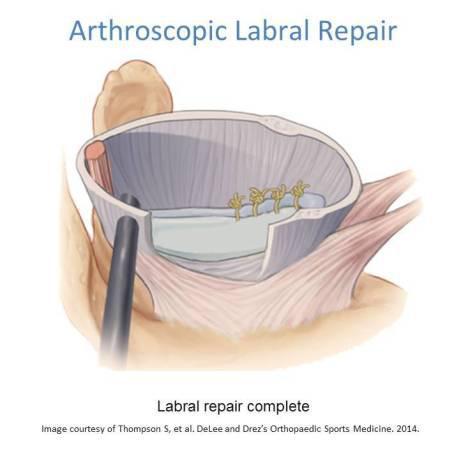 Shoulder Labral Tear- Labral Repair and Rehabilitation | Ashvin K Dewan, MD