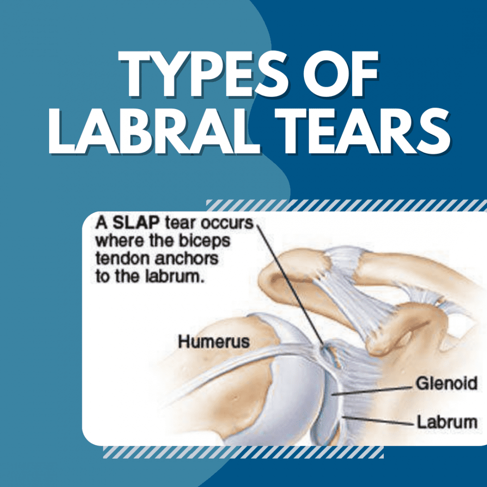 Types Of Labral Tears Ashvin K Dewan MD